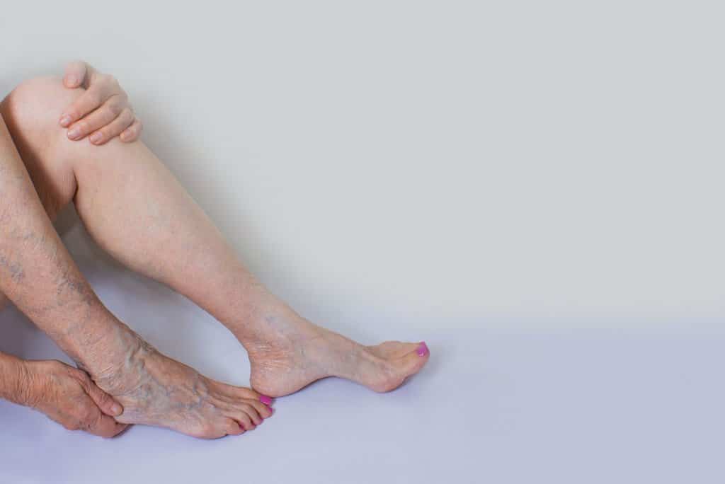 The varicose veins on a legs of old woman on gray – Intimate Wellness ...